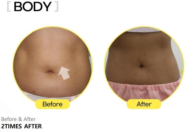 [Sid Medicos] Lemonbottle lipolysis (10ml x 5 vials) - buy online - UK ...